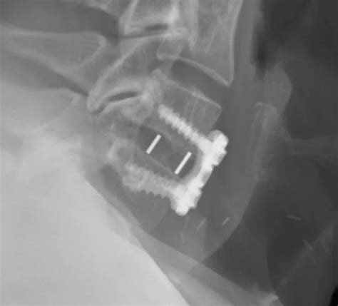 Alca Cervical