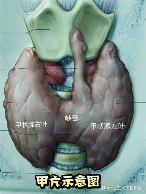 并非所有的甲状腺乳头状癌的形态都是表现为恶性形态！ 知乎