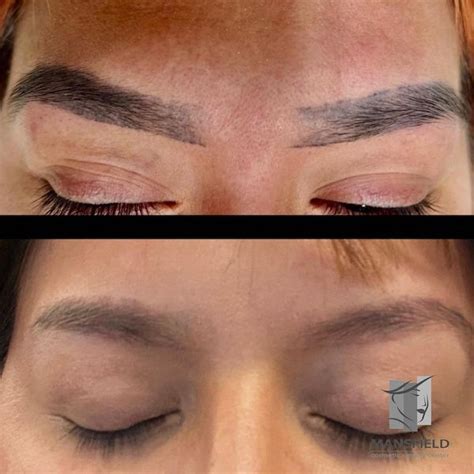 Red Eyebrows After Laser Removal At Gail Pagano Blog