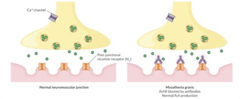 Tone And Spasticity Flashcards Quizlet
