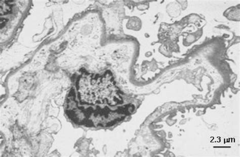 Electron Micrograph Of A Glomerular Capillary From A Patient With Hus