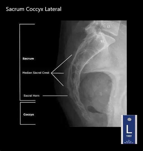 Coccyx X Ray Labeled At Juliette Bailey Blog