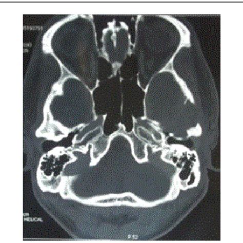 Sagittal Computed Tomography Image Showing The Mandibular Fossa Download Scientific Diagram