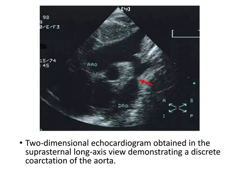 Coarctation Of The Aorta Pptx