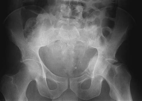 Hip Dislocation Central Radiology At St Vincents University Hospital
