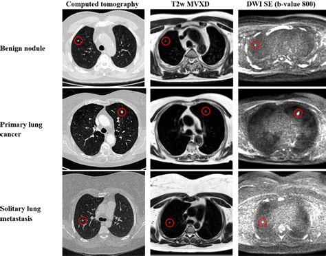 Figure 2 From Evaluation Of Pulmonary Nodules By Radiologists Vs Radiomics In Stand Alone And