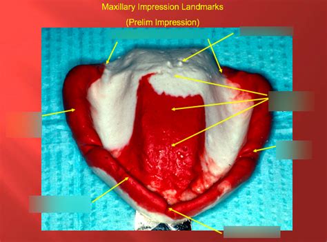 Maxillary Impression Landmarks Diagram Quizlet