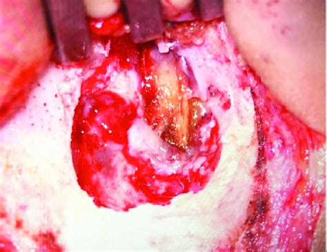 Microscopic View Of A Piece Of Wood Extending Into The Mastoid Bone