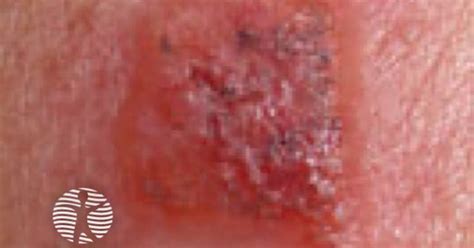 Positive Patch Test Image