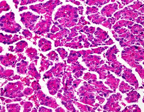 Choroid Plexus Carcinoma Light Micrograph Stock Image C049 9232 Science Photo Library