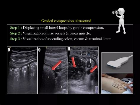 Emergency Ultrasound Course Lecture 04 Acute Appendicitis Part 1 Pdf