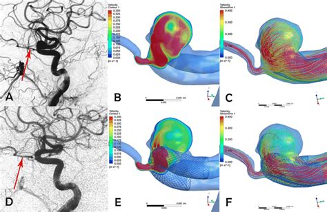 Flow Conditions Before And After Pipeline Embolization Device