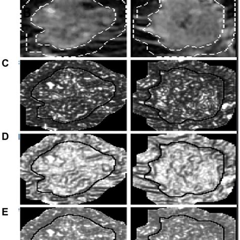 Pdf Mri Texture Features From Tumor Core And Margin In The Prediction Of Response To