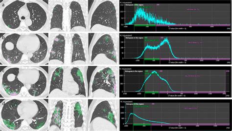 After The Segmentation Of Infected Regions Automatic Extraction Of Ggo Download Scientific