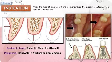 Ridge Augmentation Pptx