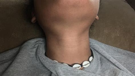 Lumps Under Jaw Rmedical