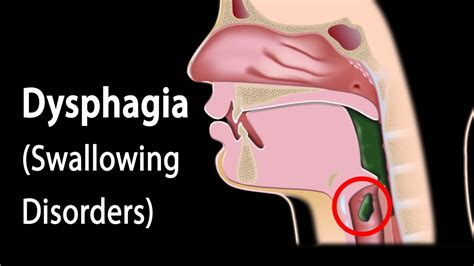 Dysphagia Animation Youtube