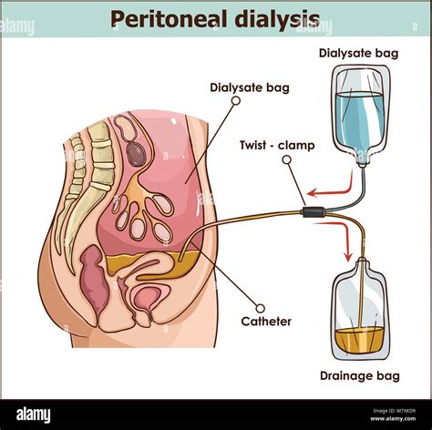 La Dialyse Péritonéale Sont Tous Deux Utilisés Pour Traiter L