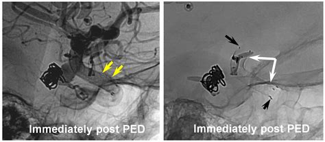 Pipeline Device Aneurysm Selection