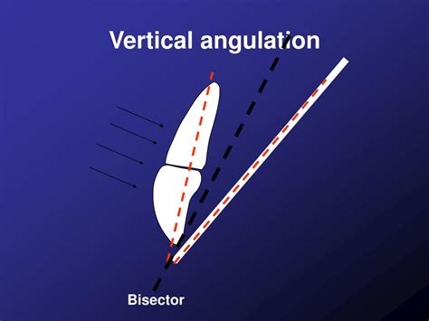 Ppt Intraoral Radiographic Techniques Powerpoint Presentation Free