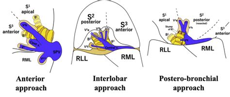 Right Upper Lobe Segmentectomy Guided By Simplified Anatomic Models Pmc