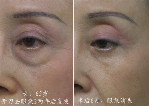 去眼袋案例图片