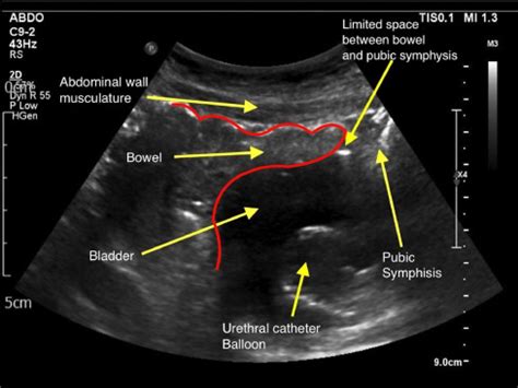Novel Use Of Hydrodissection For The Insertion Of Suprapubic Catheter