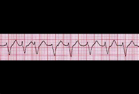 2 Cases Of Arrhythmogenic Syncope In Adolescents