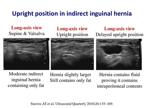 Groin Ultrasound Sonography Of Inguinal Region Zrcpi