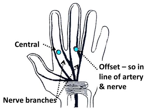 Flexor Sheath Ganglion