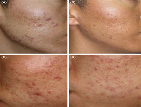 Salicylic Acid Peels Versus Jessners Solution For Acne Vulg