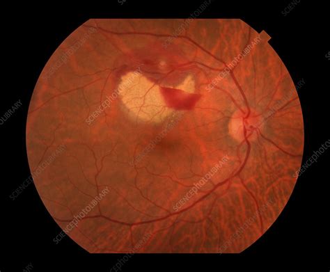 Retinal Artery Macroaneurysm Stock Image C030 6979 Science Photo Library