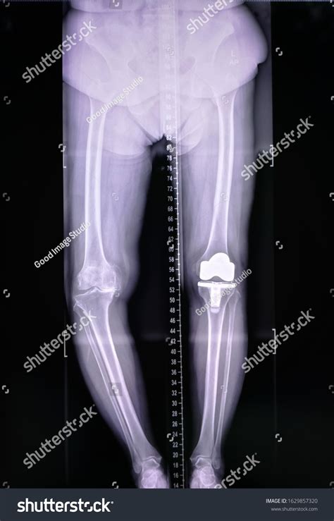 Xray Scanogram Youtube