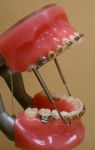 Forsus Orthodontic Appliance