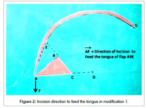 Scalp Rotation Flap Minor Changes Major Gains