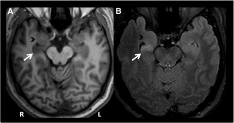 Amygdala Enlargement Occurs In Patients With Mesial Temporal Lobe