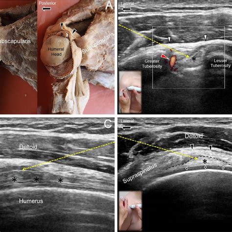 Ultrasound Guided Injection For The Suprascapular Nerve Notes A