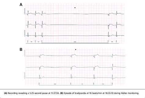Preprocedural Holter Monitoring Download Scientific Diagram