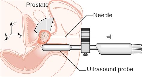Schematic Representation Of A Typical Brachytherapy Procedure