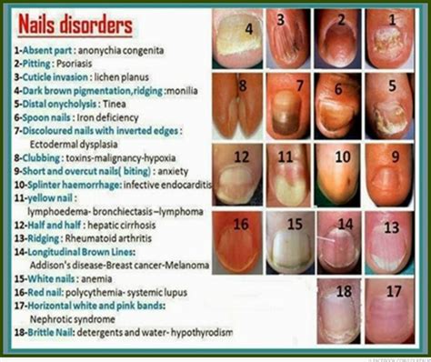 The Nails Have It Medical Facts Remedios Para La Salud Salud De Las