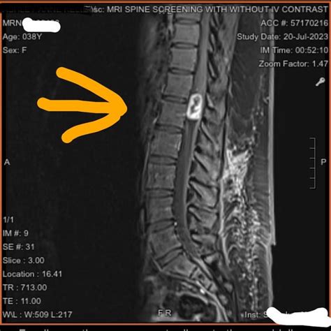 Bulging Disc And Proper Sitting Posture Rsciatica