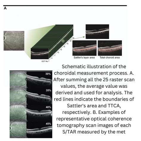 Retina Longitudinal Assessment Of Choroidal Structure In