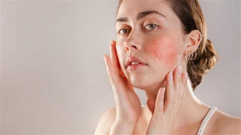 Eczema Vs Rosacea How To Tell The Difference Entirely Health