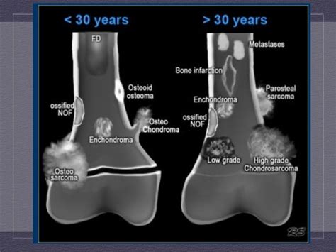 Enchondroma With Secondary Aneurysmal Bone Cyst
