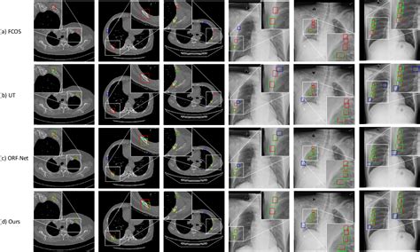 Deep Omni Supervised Learning For Rib Fracture Detection From Chest Radiology Images