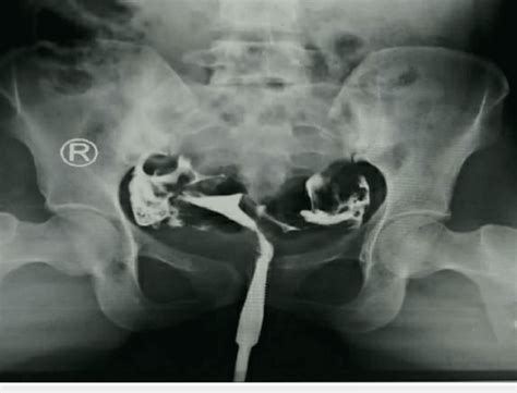 Bilateral Spillage Of Contrast In Hysterosalpingography Hsg Download Scientific Diagram