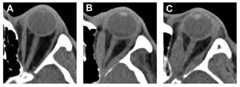 Ophthalmology Thyroid Mri
