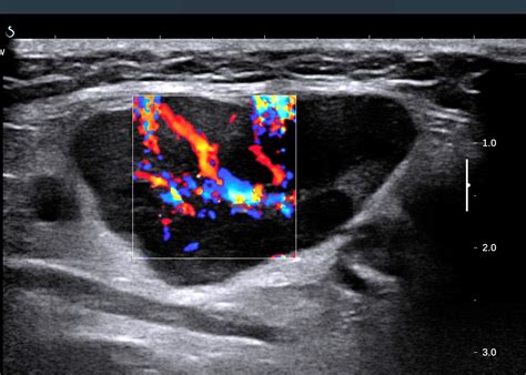 Cervical Lymph Nodes