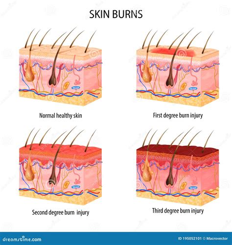 Realistic Skin Burn Classification Royalty Free Illustration 195052101