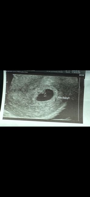 Got My First Ultrasound At 6w2d We Were Able To Seehear Its Little